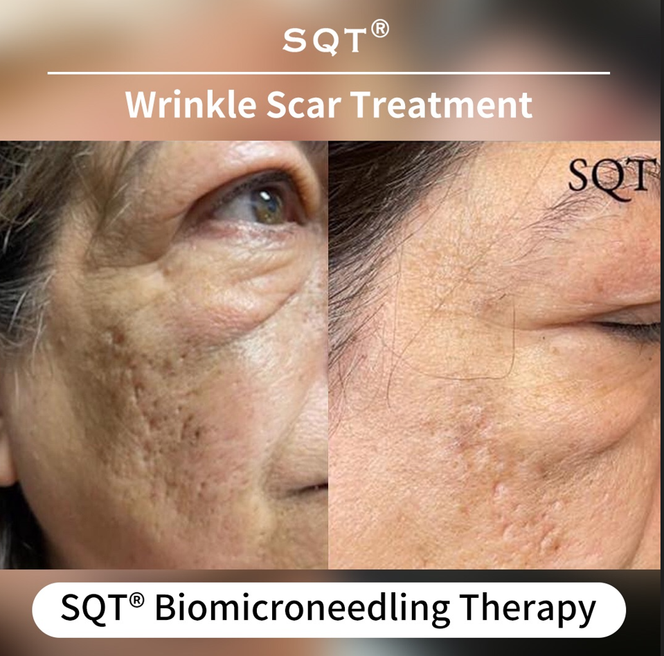 SQT Bio Microneedling