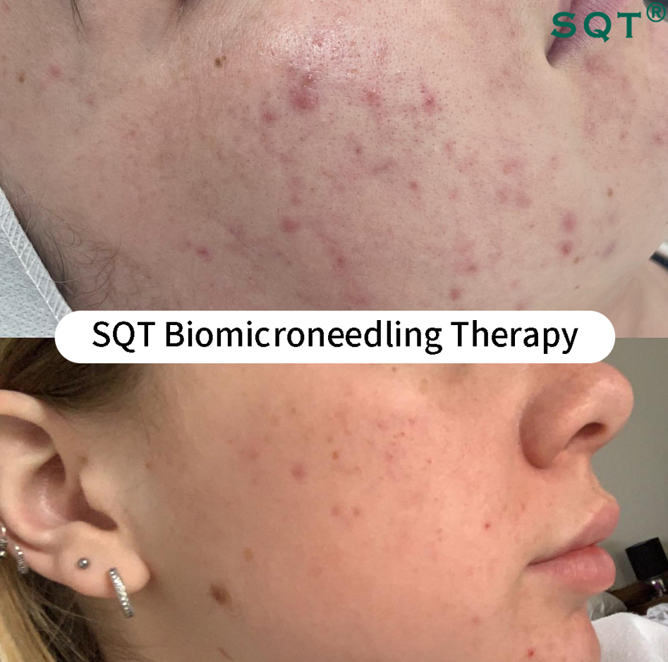 SQT Bio Microneedling